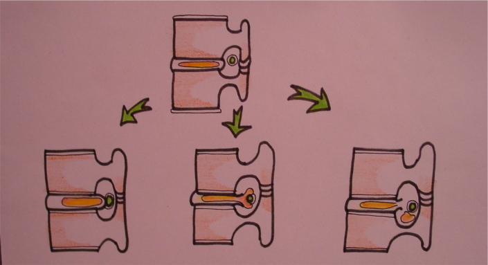 Lumbar Prolapsed Intervertebral Disc – A Treatment Algorithm – Journal ...